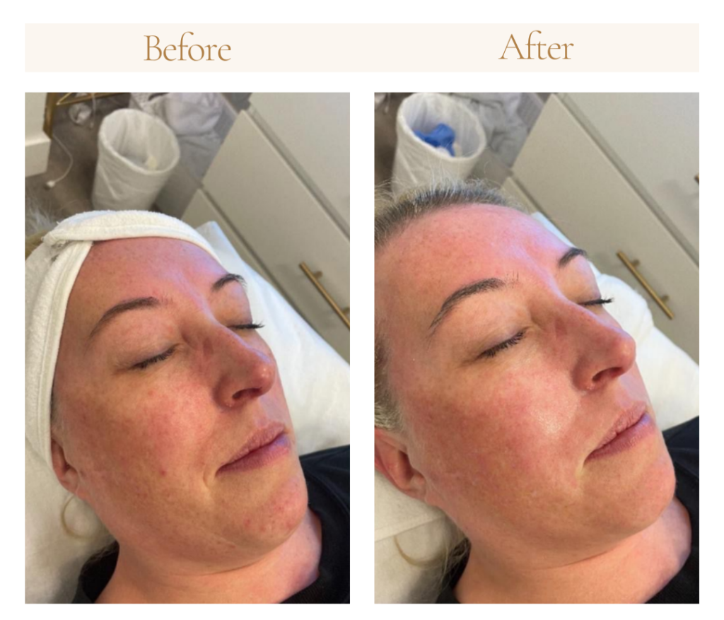Chemical Peel | Skin Resurfacing | You Glow Aesthetics