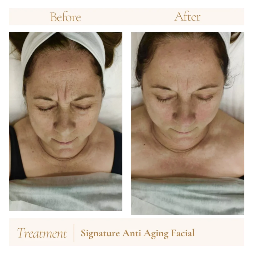 Signature Facial Treatment | You Glow Aesthetics