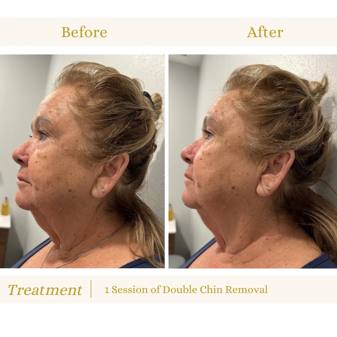 Double Chin Removal Without Surgery: Options in Calgary SE