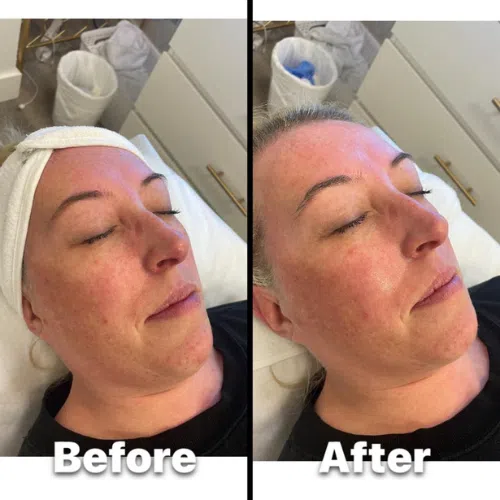 Blue Light Therapy | Clear & Calm Skin | You Glow Aesthetics