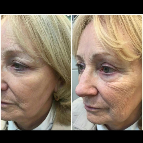 Dermaplaning Facial in Canada | You Glow Aesthetics