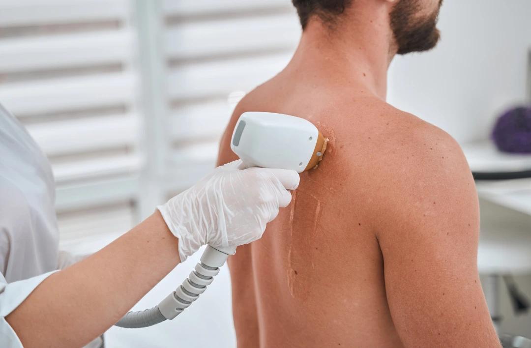 Full Back Laser Hair Removal | You Glow Aesthetics