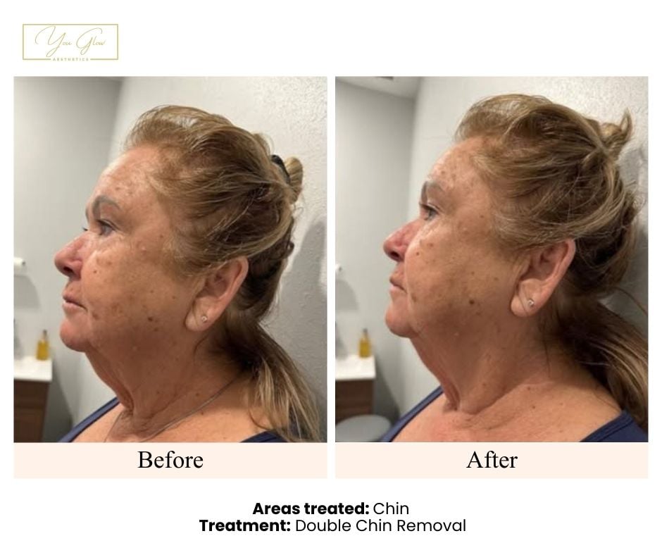 Before & After | Transformations at You Glow Aesthetics