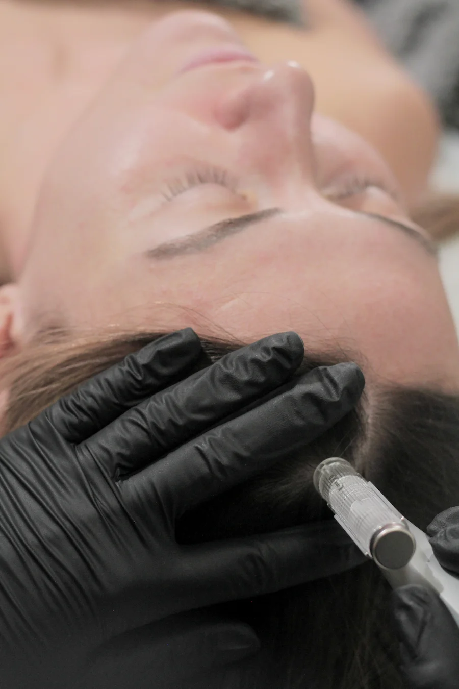 Scalp Microneedling Treatment (Hair Restoration) | You Glow Aesthetics